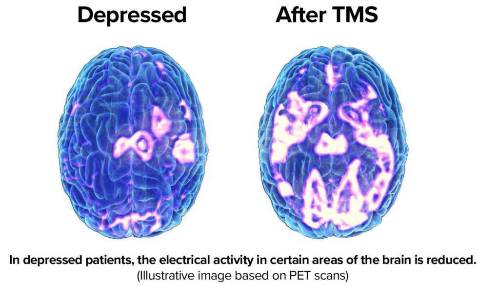 Transcranial Magnetic Stimulation therapy Orange County, CA