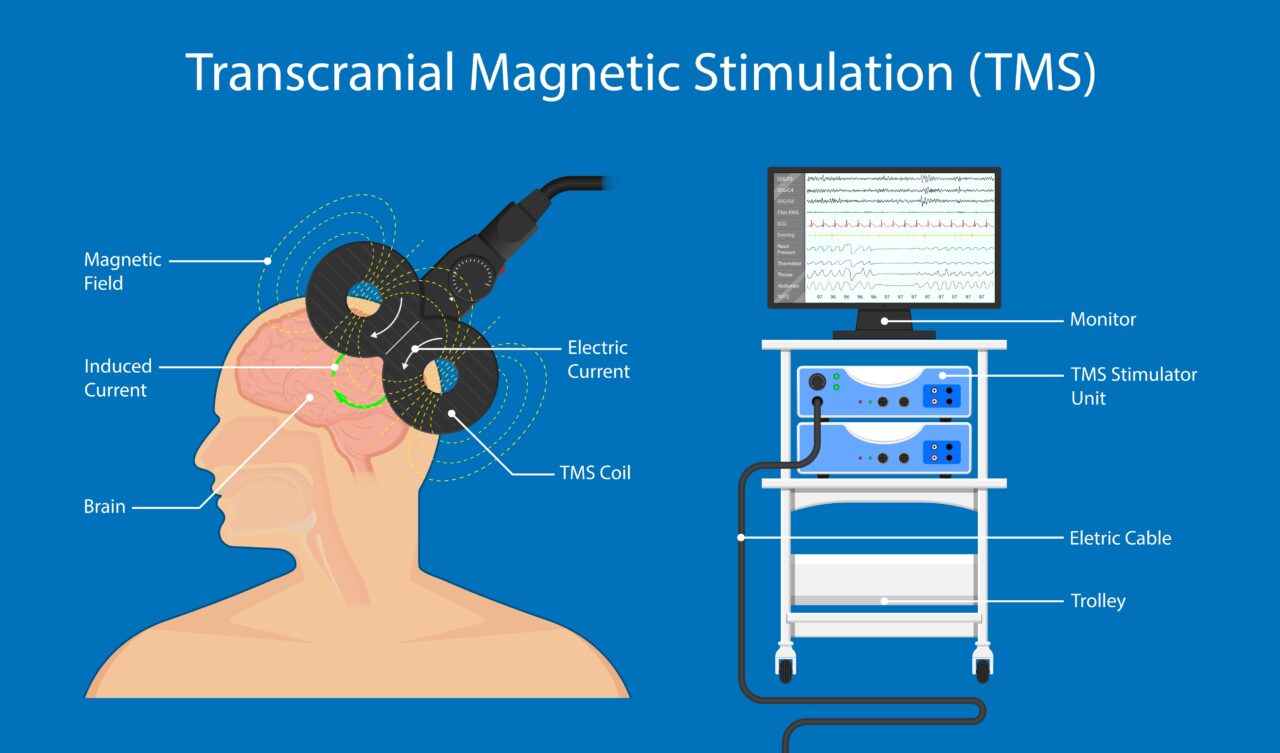 Transcranial Magnetic Stimulation therapy Orange County, CA